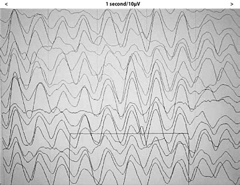 Example Of 1 Second Of The First Burst In Evidence The General