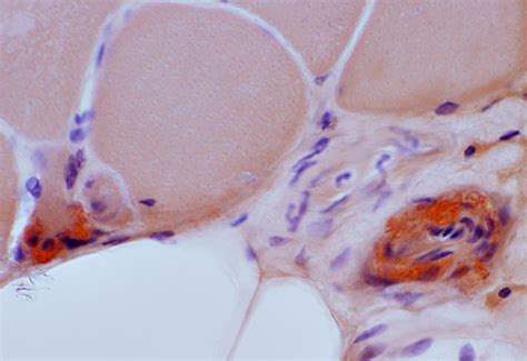 Dysferlin Deficiency