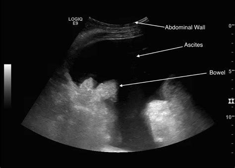 Paracentesis Procedure