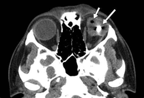 Ct Of Globe Rupture Analysis And Frequency Of Findings Ajr