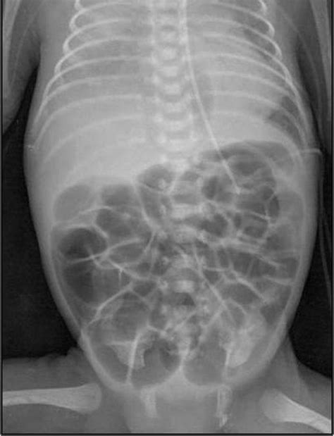 Qué Hacer Con El Recién Nacido Obstruido Radiología