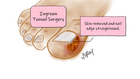 Toenail Removal Ingrown Toenails Foot And Podiatry Surgery
