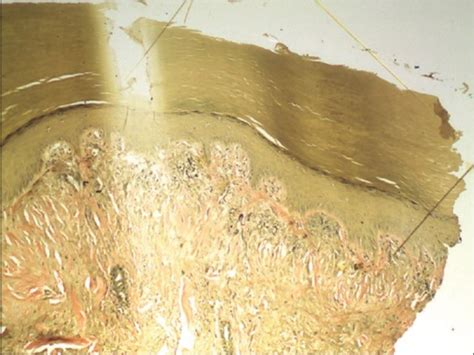Acrokeratoelastoidosis Pmc