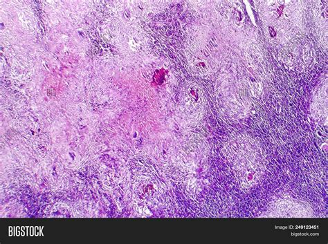 Caseous Necrosis Of Lymphatic Node Light Micrograph Photo Under