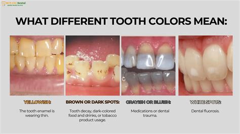 Brown Stains On Teeth Causes And Fixes Dental Secrets Dr Cuong Ho Chi Minh City Dental Clinic
