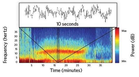 General Anesthesia Causes Telltale Brain Activity Patterns The