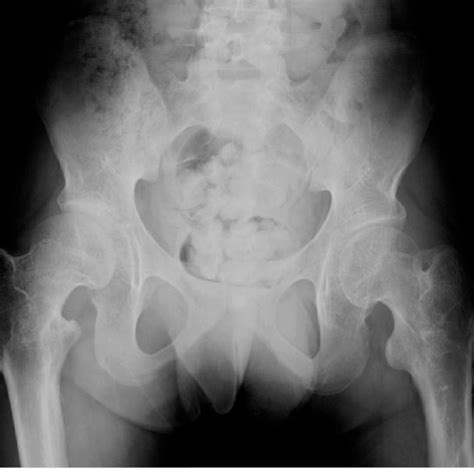 Radiographs And Diagrams Showing The Hip Classification System In Download Scientific Diagram