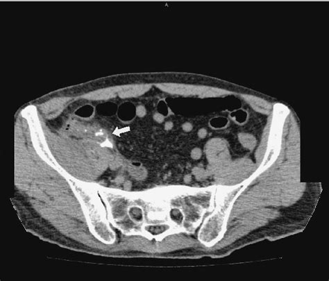 Figure 1 From A Case Of Retroperitoneal Abscess Arising From A
