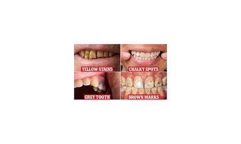What Your Tooth Colour Reveals About Your Health Science Explains