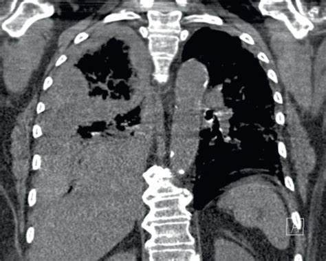 A Chest Ct Showing Large Right Sided Hemothorax As A Complication Of