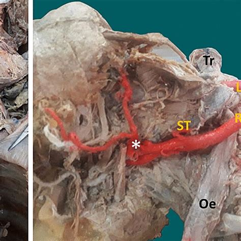 Schematic Diagram Of The Double Aortic Arch The Left And Right Aortic