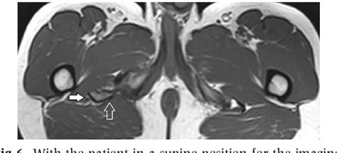 Figure 16 From Chronic Ischial Avulsion Fracture Excision With Primary