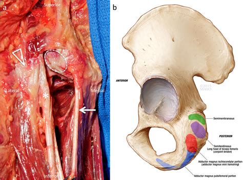 Posterior Exposure Of The Ischial Tuberosity In A Cadaveric Specimen
