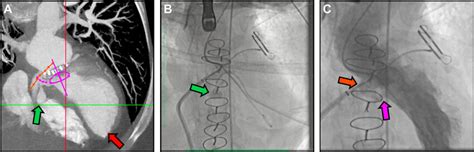Computed Tomography Correlation With Fluoroscopy Download Scientific Diagram