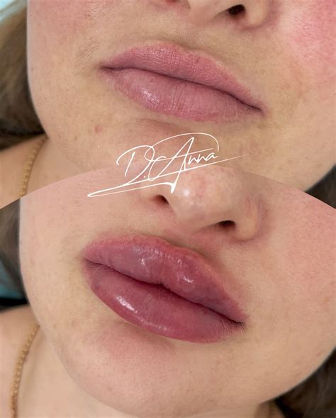 Dr Anna Dha Licensed Gp Aesthetic Doctor Drannadubai