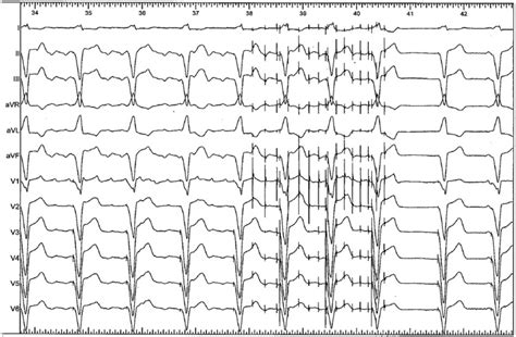 Atrial Anti Tachycardia Pacing Resulting In Termination Of Atrial Flutter Intracardiac Atrial Anti Tachycardia Pacing Resulting In Termination Of Atrial Flutter Intracardiac