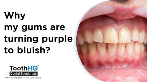 Why My Gums Are Turning Purple To Bluish Dallas Abp Board Certified