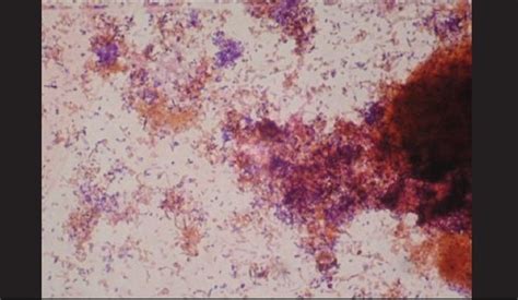Gram Stain With Predominance Of Gram Negative Coccobacilli Download