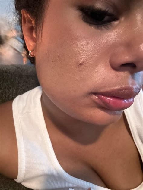 Hormonal Cystic Acne Rblackskincare