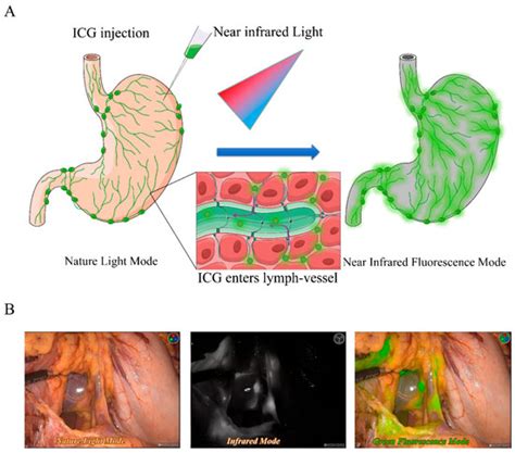 Mapping Lymph Node During Indocyanine Green Fluorescence Imaging Guided Gastric Oncologic