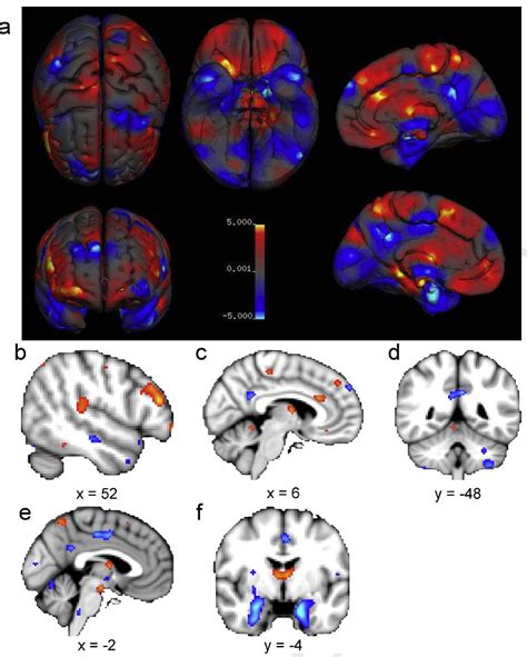 Pdf A Meta Analysis Of Sex Differences In Human Brain Structure
