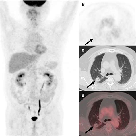 Imaging And Clinical Characteristics Of Ectopic Cushing Syndrome