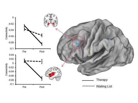 Mri Brain Scan Ptsd 7 Tesla Mri Opening Doors About Traumatic Brain