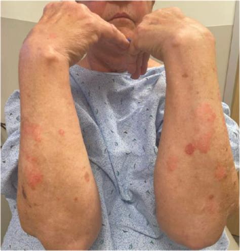 Dermatitis In The Elderly