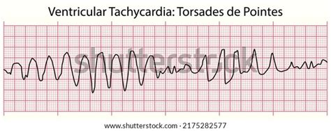 Ventricular Fibrillation Vs Torsades De Pointes