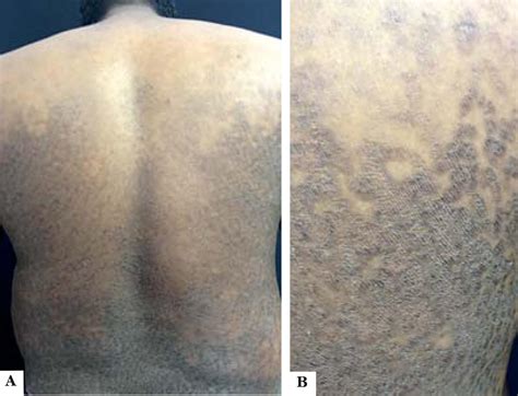 Can Uv Light Cause Confluent And Reticulated Papillomatosis Srxq
