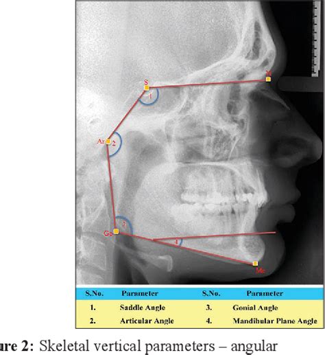 Figure 1 From Diagnostic Features Of Angles Class Ii Div 2
