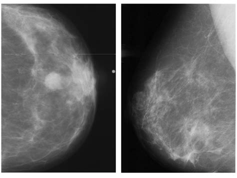 Normal V Abnormal Mammogram Illustrative Case Reports Radiology Key