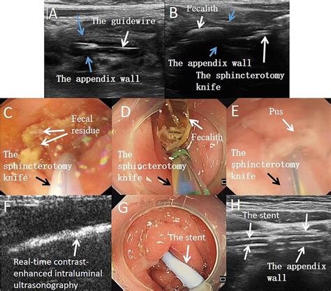 The Procedure Of The Modified Endoscopic Retrograde Appendicitis Download Scientific Diagram