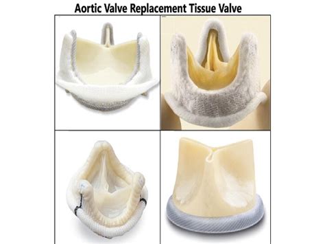 Aortic Valve Replacement Tissue Valve Baberahma