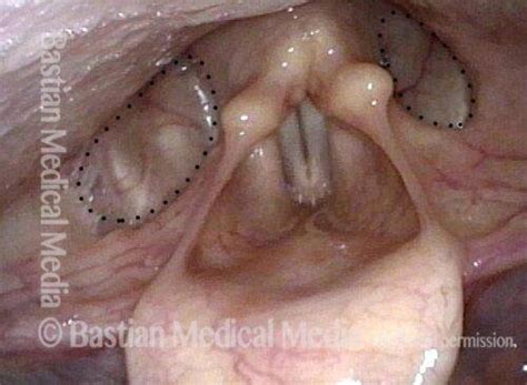 Pyriform Sinus Laryngeal Anatomy With Pictures