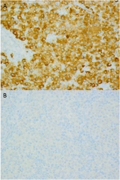 Kappalambda 20 × The Lymph Node Infiltrate Demonstrated