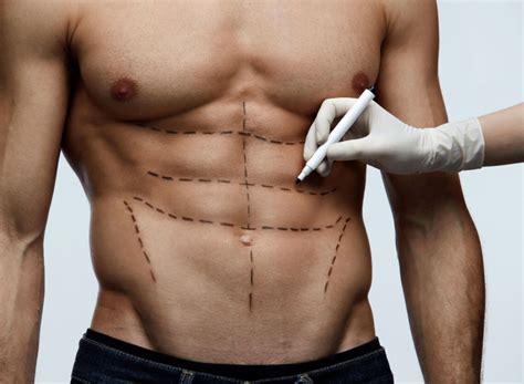 Top 5 Most Popular Plastic Surgery Procedures For Men