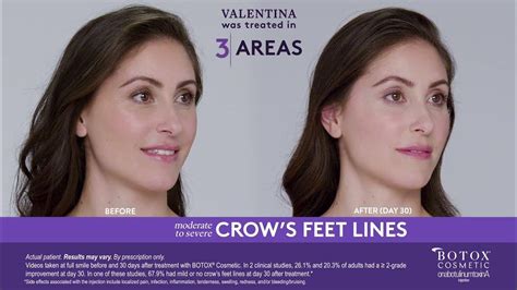 Botox Twins Treatment Youtube