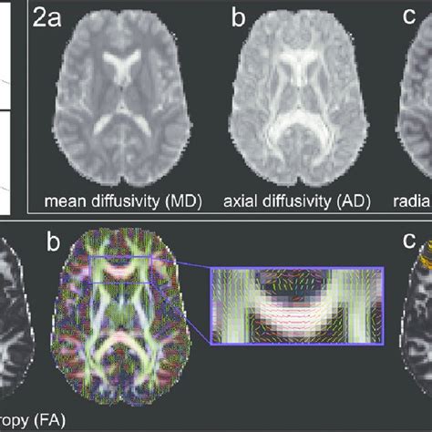Diffusion Tensor Imaging 1 The Diffusion Tensor Model Showing