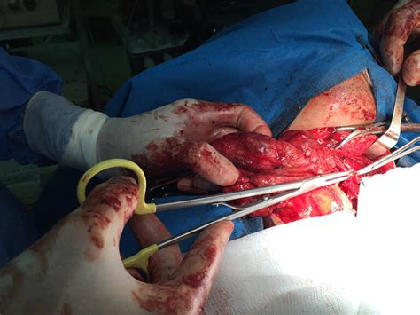 Difficult Total Thyroidectomy For Recurrent Multinodular Goiter Dr