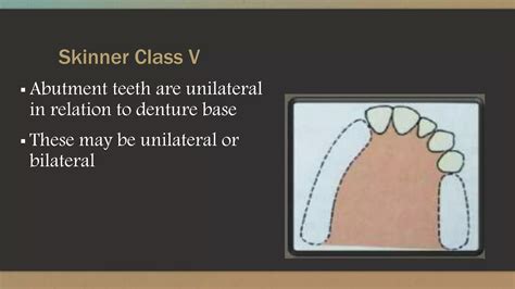 Classification Of Rpd Lecture Ppsx