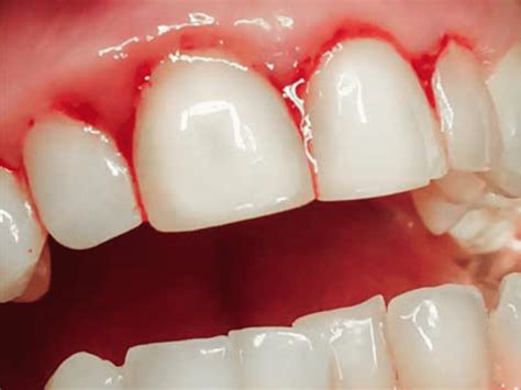 Bleeding Gums Dean Dental Clinic