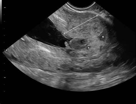 Placenta Accreta Spectrum Obstetrics And Gynecology Clinics