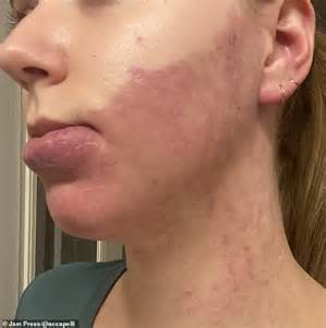 Woman 28 Who Was Born With A Large Port Wine Stain Birthmark Across Her Face Becomes A Viral