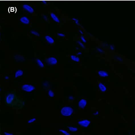 Igg4 Staining In Active Eoe A Inactive Eoe B And Control C ×40