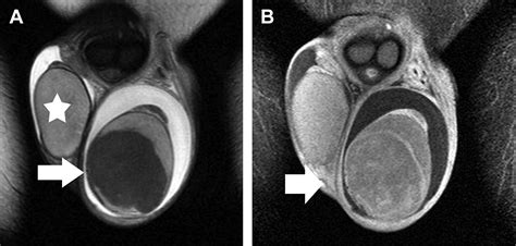 Mr Imaging Of Scrotum Magnetic Resonance Imaging Clinics