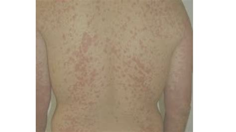 Effective Homeopathic Remedies For Skin Eruptions Homeo Remedies