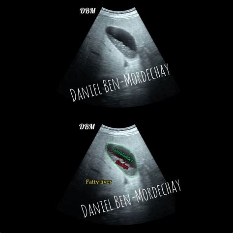 Ultrasound Pocus Gallbladder Sludge Fatty Liver Daniel Ben Mordechay