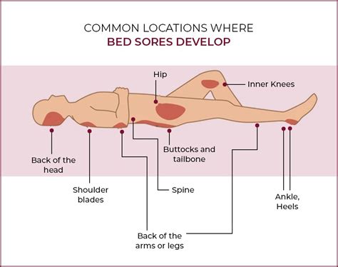 When Caring For A Client Who Is On Bed Rest What Should You Do To