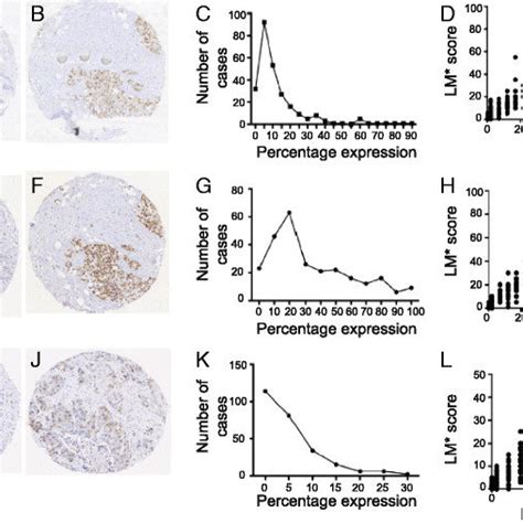 Expression Of Proliferation Markers In Invasive Breast Cancers